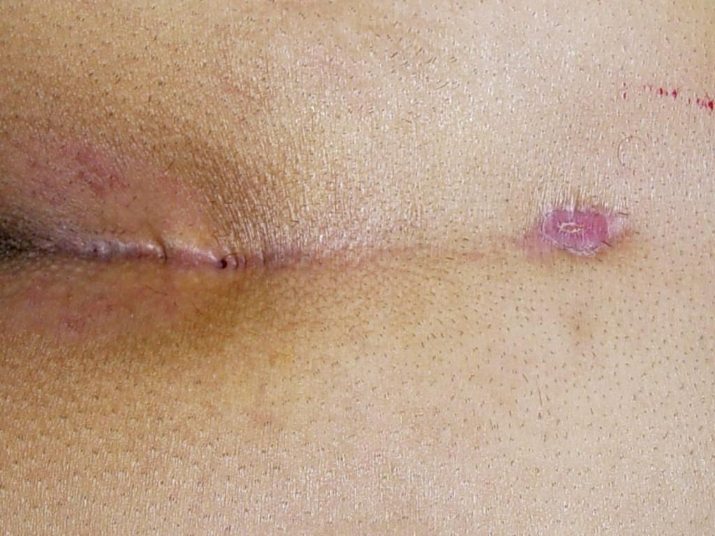 Alles Over Diagnosestelling Van Sinus Pilonidalis Op Een Rij